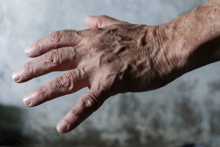 Why Do I Have Veiny Hands? - Vein Specialists in Dayton, OH